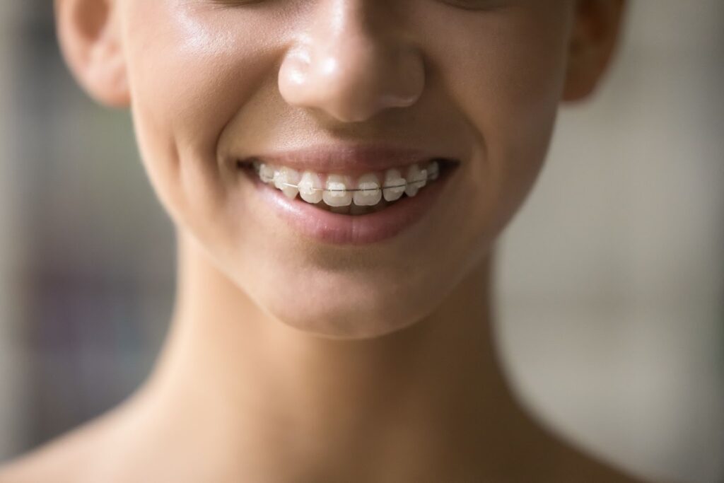 A Beginner’s Guide to Clear Braces | Timock Family Orthodontics
